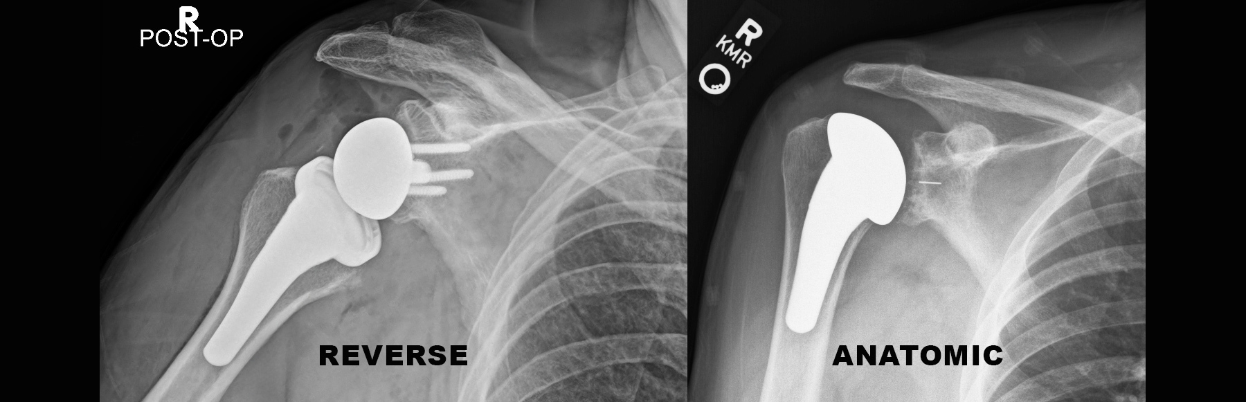 Anatomic vs Reverse Shoulder Replacement- Key Differences