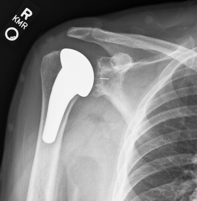 Anatomic vs Reverse Shoulder Replacement- Key Differences